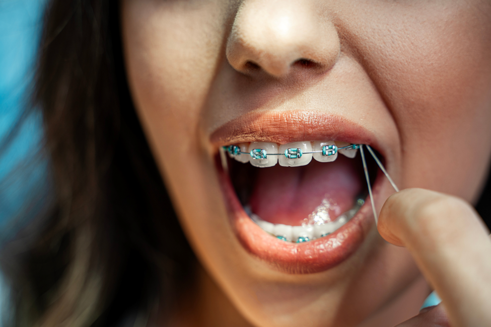 Why Do I Need to Wear Rubber Bands with My Braces? | Simply Orthodontics Derry & Hudson